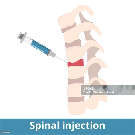 Spinal Injection Stock Illustration Download Image Now Epidural