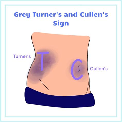 Turners Sign Cullens Sign Medical School Essentials Diagnostic