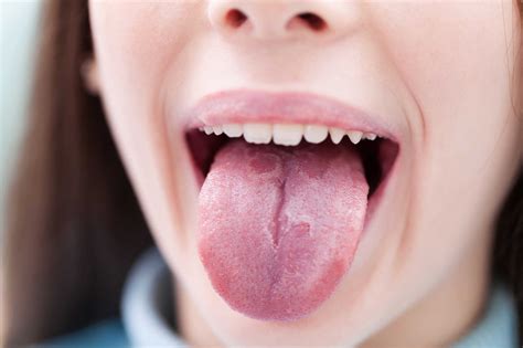 Bệnh Viêm Lưỡi Nguyên Nhân Biến Chứng Và Cách điều Trị