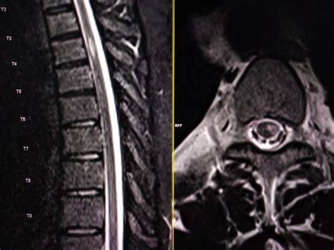 Plaque Of Multiple Sclerosis Multiple Sclerosis Radiology Movie Posters