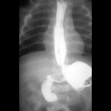 Malrotation With Midgut Volvulus Pediatric Radiology Reference