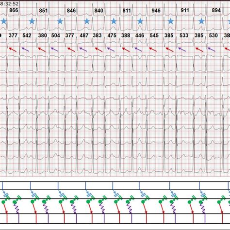 Surface 12 Leads Ecg And Intracardiac Electrograms With Annotations