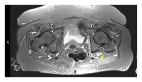 Axial Mri Stir Of The Pelvis Without Contrast There Is Asymmetric High