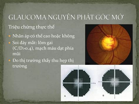 glaucoma pdf
