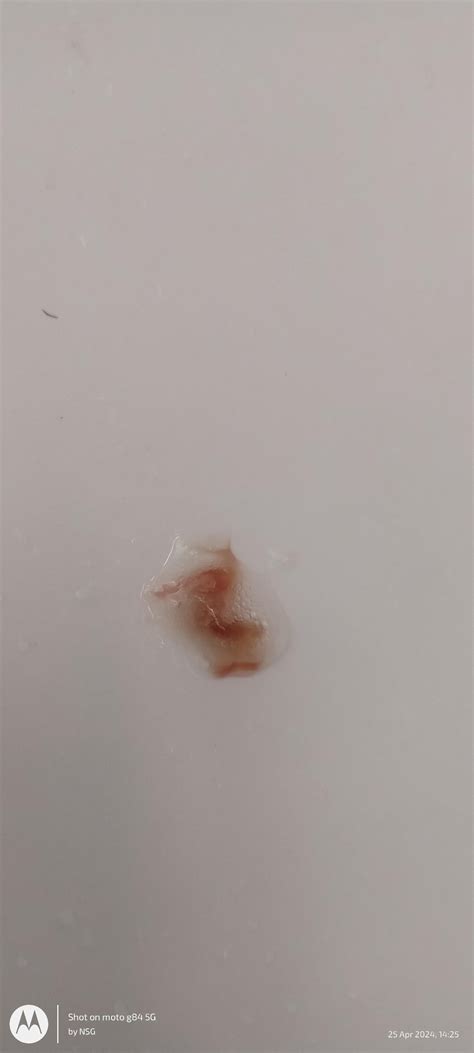 Is This Blood In Phlegm Rdiagnoseme