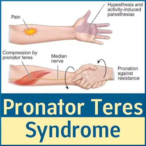 Pronator Teres Syndrome Sports Medicine Review