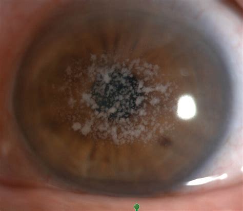The Need For Corneal Dystrophy Genetic Testing Corneal Physician