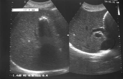 Abdominal Ultrasound Showing Gallbladder Stones And Common Bile Duct Download Scientific