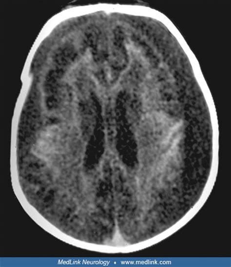 Microcephaly Medlink Neurology