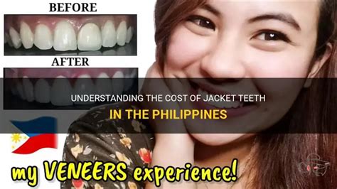 Understanding The Cost Of Jacket Teeth In The Philippines Shunvogue