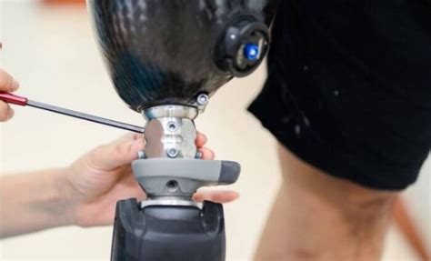 How Often Does A Prosthetic Socket Need To Be Replaced