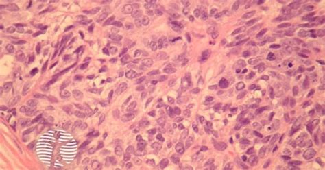 Aggressive Digital Papillary Adenocarcinoma Pathology Image