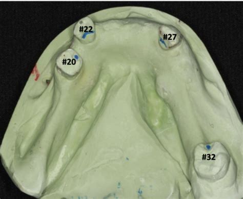 Kennedy Classification Practice Flashcards Quizlet