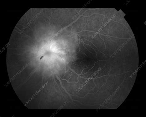 Pseudopapilledema Stock Image C027 1977 Science Photo Library