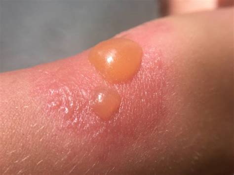 Sunburn Blisters On Hands