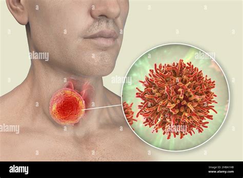 Thyroid Gland Cancer With A Close Up View Of Cancer Cells Computer