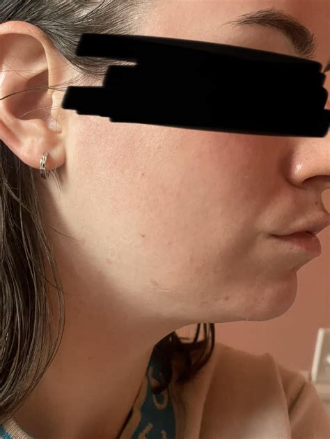 Mini Neck Lift Surgeon Recs In Northwest Usa Rplasticsurgery