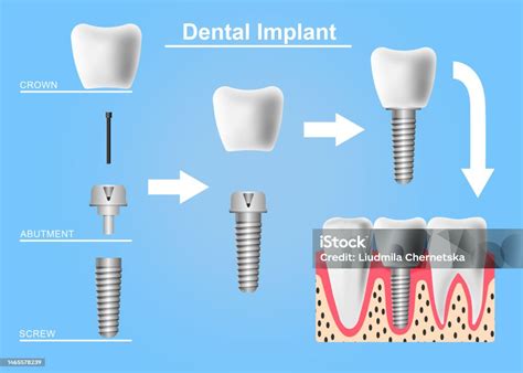 하늘색 배경에 치과 임플란트의 구조 그림 교육 포스터 0명에 대한 스톡 벡터 아트 및 기타 이미지 0명 건강관리와 의술 건축물 Istock