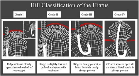 The American Foregut Society White Paper On The Endoscopic Classification Of Esophagogastric