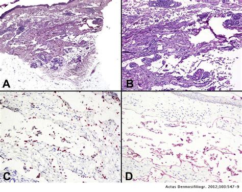 Lymphangioma Like Kaposi Sarcoma Actas Dermo Sifiliográficas