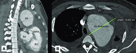 Computed Tomographic Thoracic Angiogram A Sagittal View Showing The Download Scientific