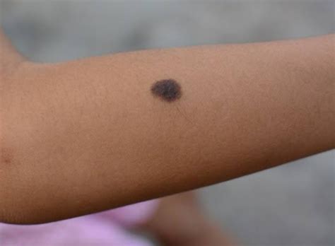 Mengenal Tentang Tompel Dan Macam Macam Tompel Bercak Gelap Pada Kulit