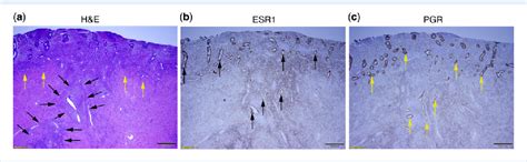 Figure 1 From Adenomyosis Pathogenesis Insights From Next Generation