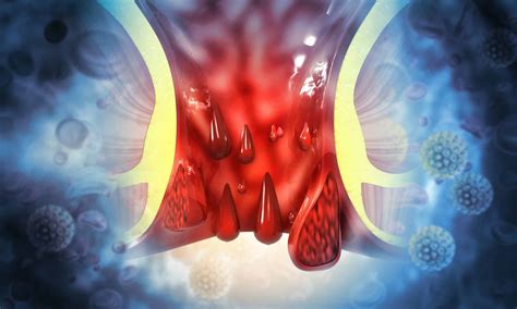 Hemorrhoids Piles Treatment Singapore Alpha Digestive