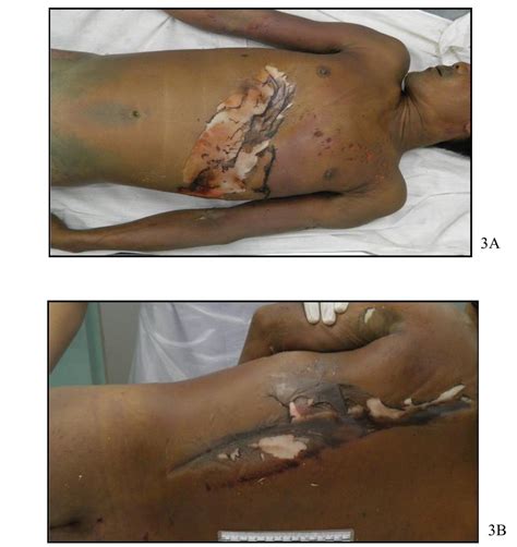 Autopsy Photos Showing The Postmortem Abrasions On The Front And Back
