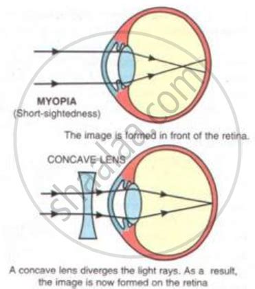 Given Below Is A Diagram Depicting A Defect Of The Human Eye Study The Same And Answer The