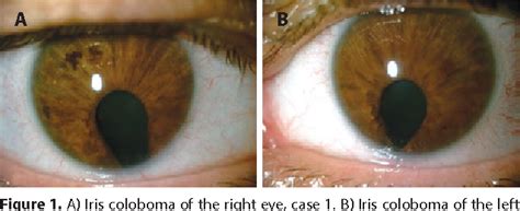 Coloboma Of The Eye