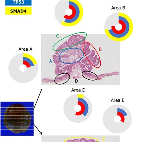 A Comparison Between The Genetic Mutations And The Histopathological Download Scientific