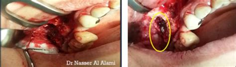 Case Report Management Of Pansinusitis With Periorbital Cellulitis