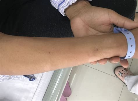 一例葡萄糖酸钙外渗的典型案例 患者