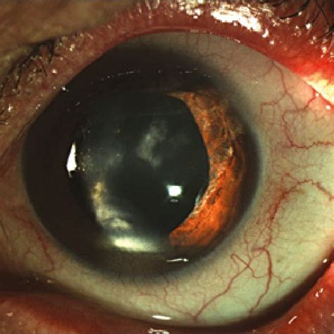 Pdf Presumed Herpetic Anterior Uveitis A Study With Retrospective