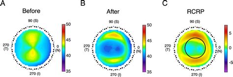 Methods To Determine Rcrp A Axial Map At Baseline B Axial Map In