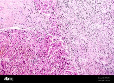 Histopathology Of Liver Abscess Light Micrograph Hematoxylin And