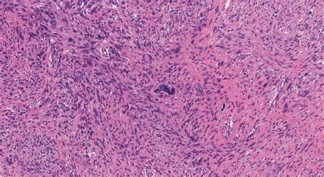 Leiomyosarcoma Of The Skin Ottawa Atlas Of Pathology