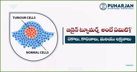 Benign tumors బనన టయమరస అట ఏమట రకల లకషణల