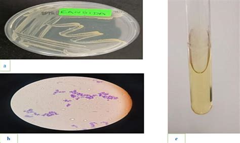 Prevalence Of Enterococcus Faecalis And Candida Albicans In Endodontic Retreatment Cases A