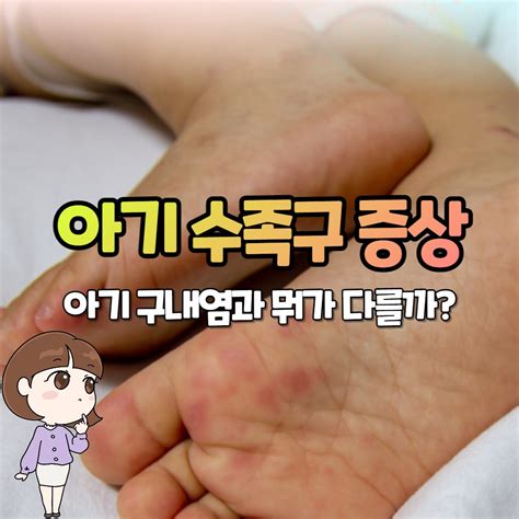 아기 수족구 증상 및 원인 Vs 유아 구내염 네이버 포스트