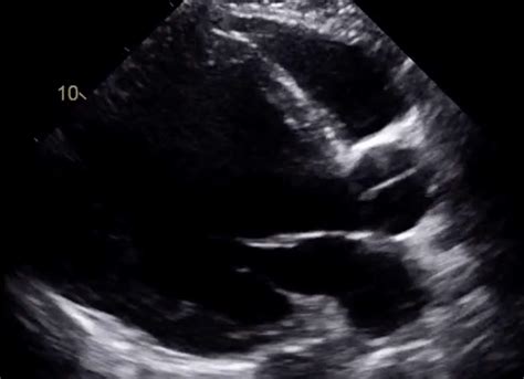 Dont Fixate On Low Ejection Fraction Rk Md