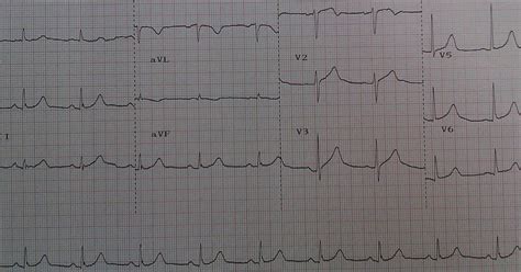 Phimaimedicine 613 Qt Prolongation