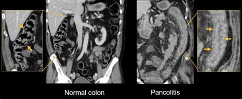 Abdominal Ct Enteritis And Colitis • Litfl • Radiology Library