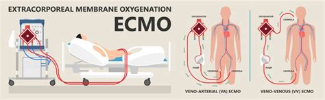 Ecmo Why The Last Resort Treatment Is On The Rise