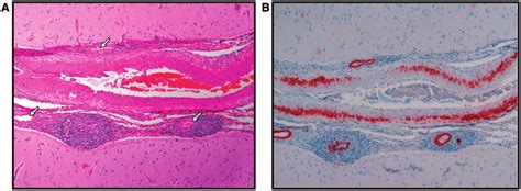 Leptomeningeal Vasculitis With Amyloid Angiopathy A Destructive