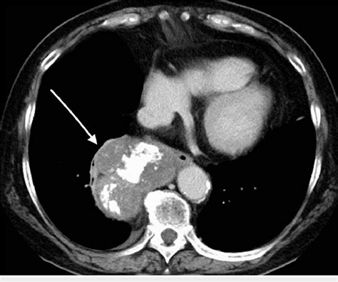 Chest Computed Tomography Findings Mediastinal Condition A Mass