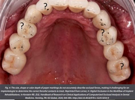 Utilizing Digital Occlusal Indicators To Increase Occlusal Accuracy And