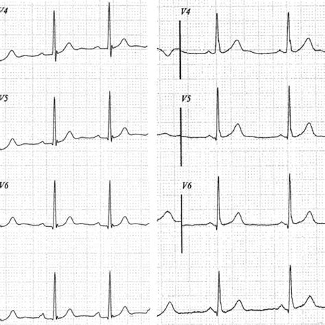 Two Distinct Variants Of Early Repolarisation In The Lateral Leads With Download Scientific