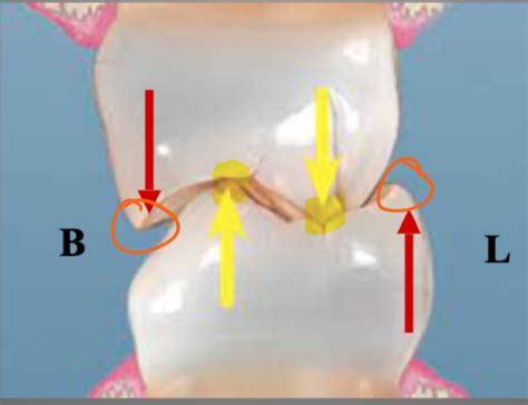 Occlusal Surfaces Contacts And Alignment Flashcards Quizlet